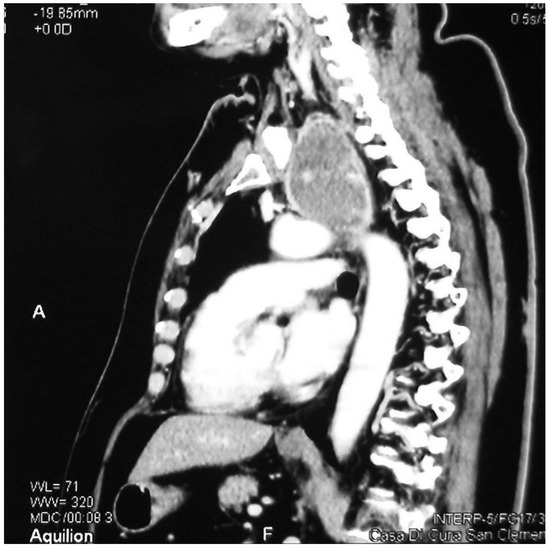 Retrosternal Goitre: Anatomical Aspects and Technical Notes