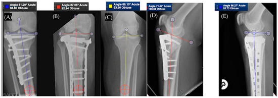 Malunion of the Tibia: A Systematic Review