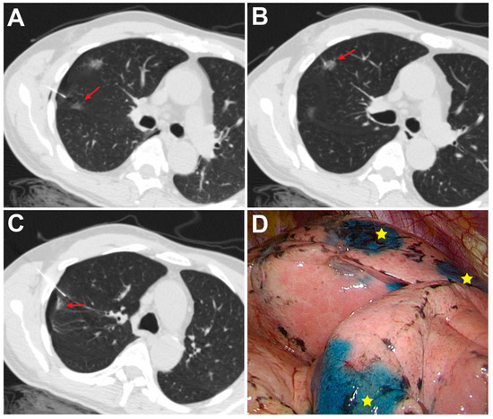 Simultaneous Patent Blue Dye Injections Aid in the Preoperative CT ...