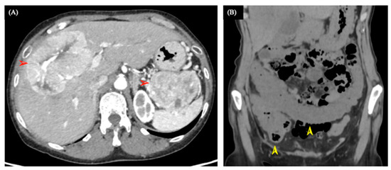 Hemorrhagic Colitis Caused by Everolimus in a Patient with ...