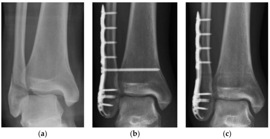 Syndesmosis Changes before and after Syndesmotic Screw Removal: A ...