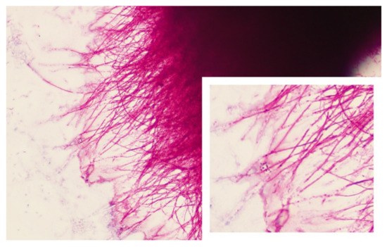 Primary Lymphocutaneous Nocardia brasiliensis in an Immunocompetent ...