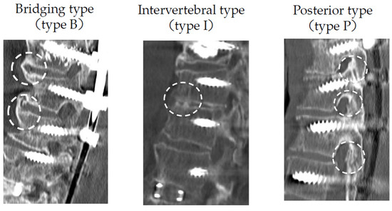 Bone Fusion Morphology after Circumferential Minimally Invasive Spine ...