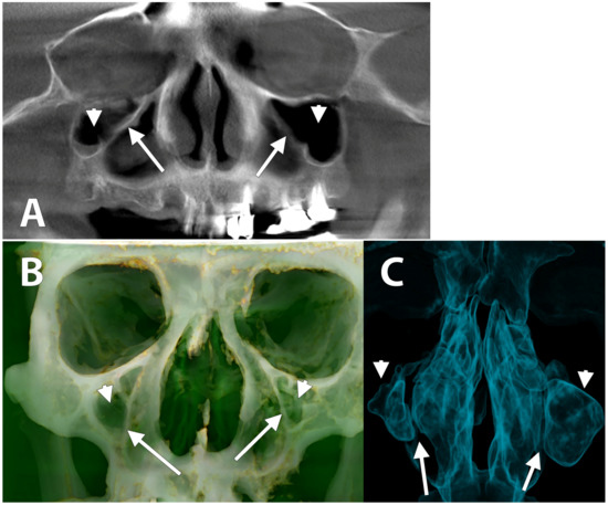 Anatomical Changes in a Case with Asymmetrical Bilateral Maxillary ...