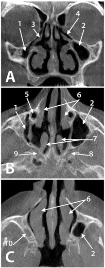 Anatomical Changes in a Case with Asymmetrical Bilateral Maxillary ...
