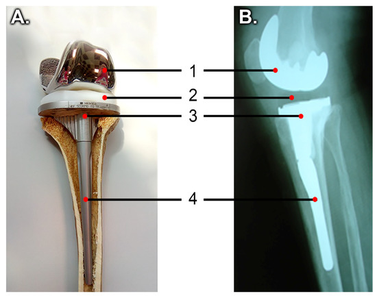 Tibial Stem Extension versus Standard Configuration in Total Knee ...