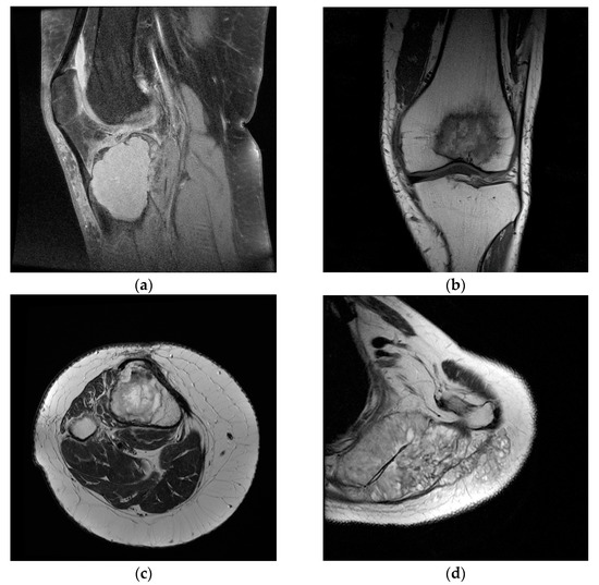 Malignant Bone Tumors Diagnosis Using Magnetic Resonance Imaging Based ...