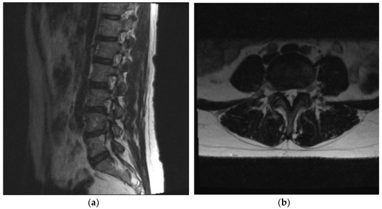 A Modified Approach for Minimally Invasive Tubular Microdiscectomy for ...