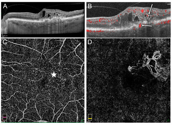 Intraretinal Cysts as a Manifestation of Retinal Angiomatous ...