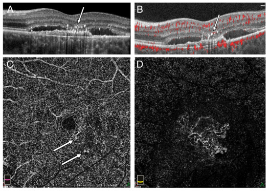 Intraretinal Cysts as a Manifestation of Retinal Angiomatous ...