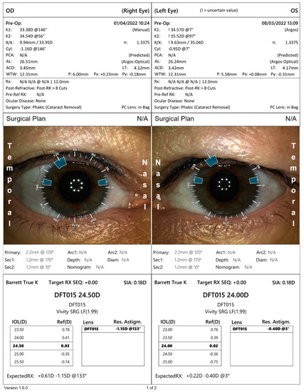Cataract Surgery after Radial Keratotomy with Non-Diffractive Extended ...