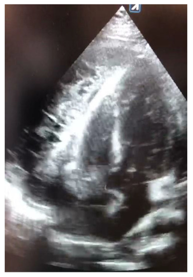 A Rare Case of Effusive-Constrictive Pericarditis Caused by ...