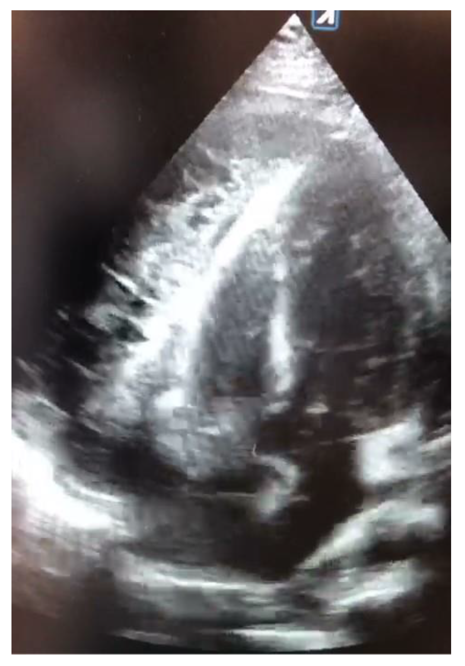 Medicina Free Full Text A Rare Case Of Effusive Constrictive