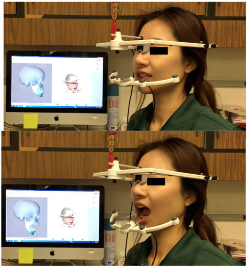 An Evaluation of Jaw Tracking Movements in Patients with Total Joint ...