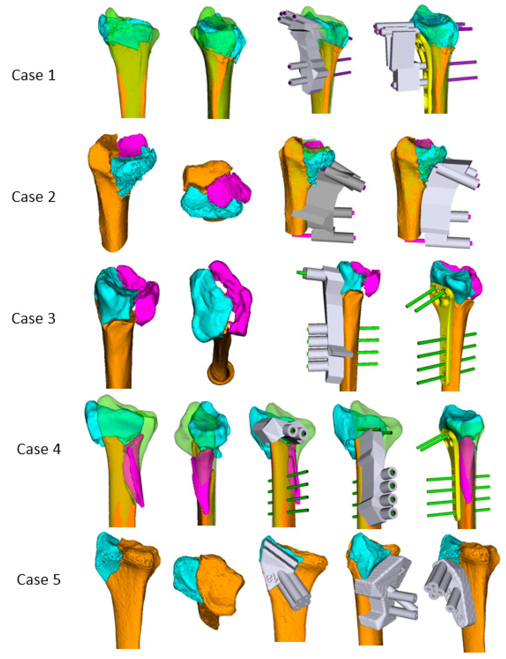 Medicina Free Full Text Three Dimensional Planning And Patient
