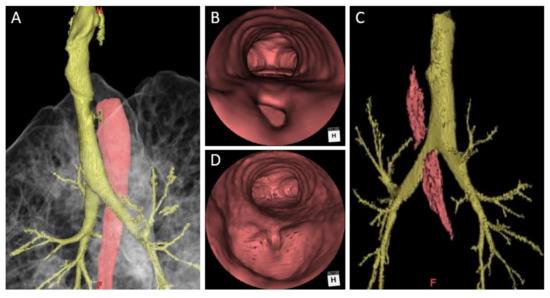 Tracheoesophageal Fistula In Adults