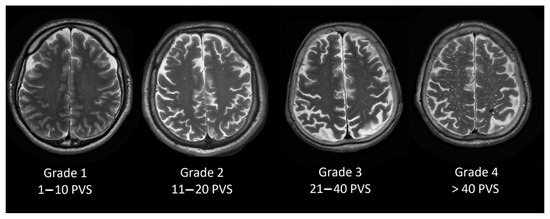 Combined Score of Perivascular Space Dilatation and White Matter ...