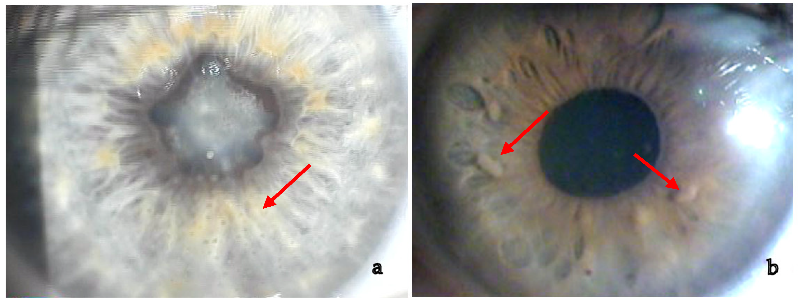 Uveitis Anterior Nongranulomatous Background
