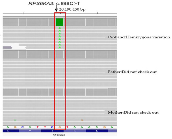 Coffin-Lowry Syndrome Induced by RPS6KA3 Gene Variation in China: A ...