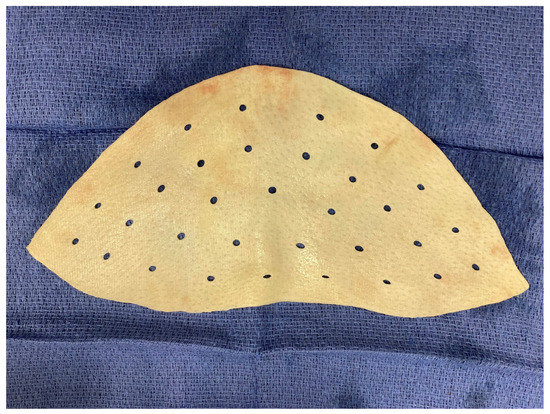 Pre-Pectoral One-Stage Breast Reconstruction with Anterior Coverage ...