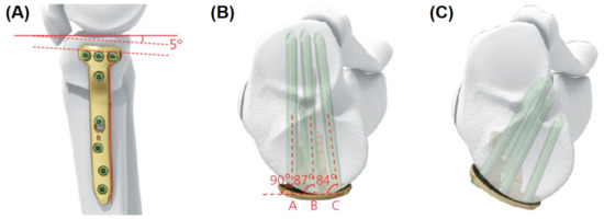 Medicina | Special Issue : Advances in Knee Surgery