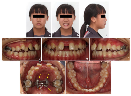 Management of Class III Malocclusion and Maxillary Transverse ...