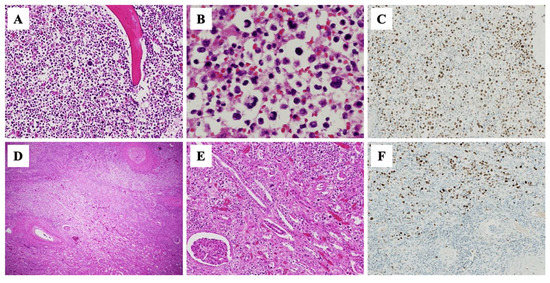 Renal Leukemic Infiltration Overlapping Acute Focal Bacterial Nephritis ...