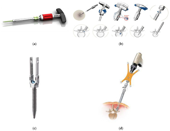 The History and Development of the Percutaneous Pedicle Screw (PPS) System