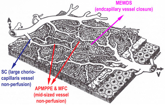 Acute Posterior Multifocal Placoid Pigment Epitheliopathy (APMPPE): A ...