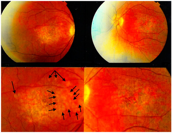 Acute Posterior Multifocal Placoid Pigment Epitheliopathy (APMPPE): A ...
