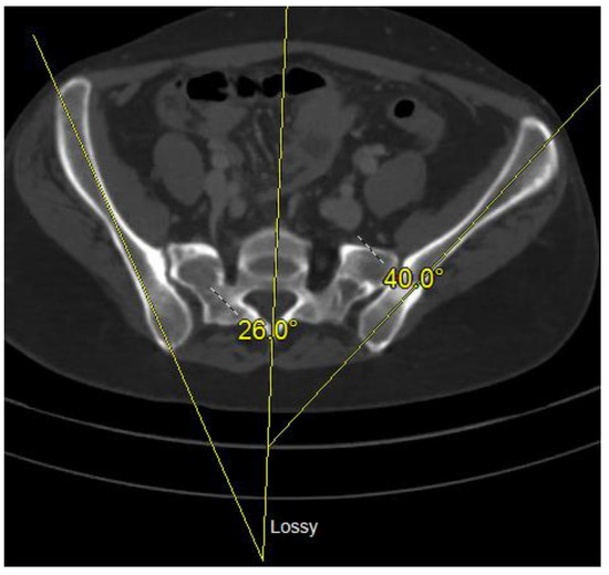 Pelvic Malunion: A Systematic Review, Dichotomy of Definitions and ...