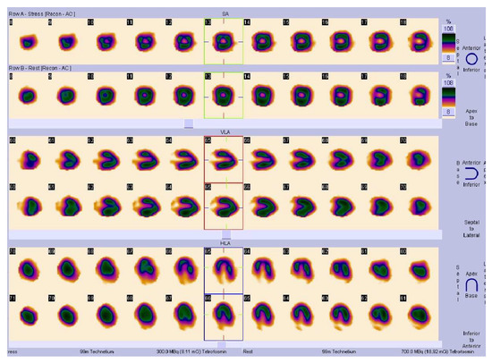 Coronary Artery Disease in Women: Lessons Learned from Single-Center ...
