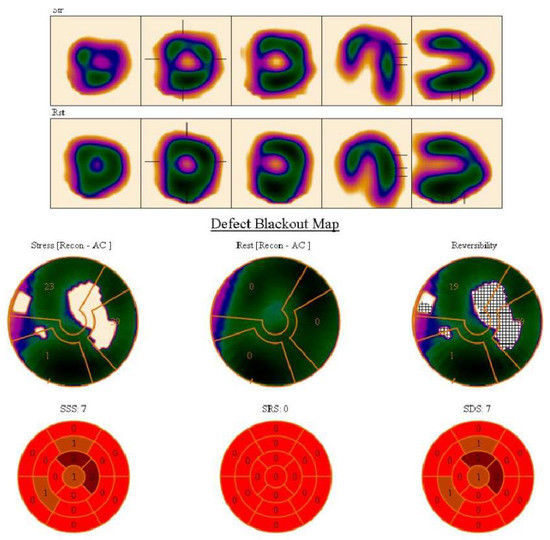 Coronary Artery Disease in Women: Lessons Learned from Single-Center ...