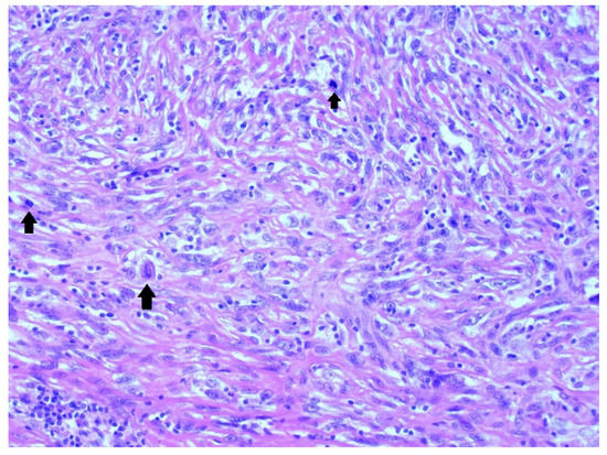Highly Aggressive Osteosarcoma of the Ethmoids and Maxillary Sinus-A ...
