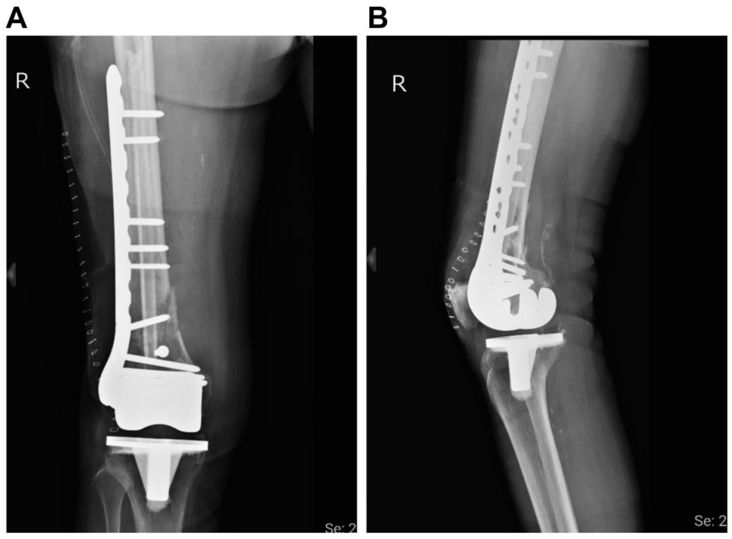Surgical Outcomes Of Dual Plate Fixation For Peripros - vrogue.co Surgical Outcomes Of Dual Plate Fixation For Peripros - vrogue.co