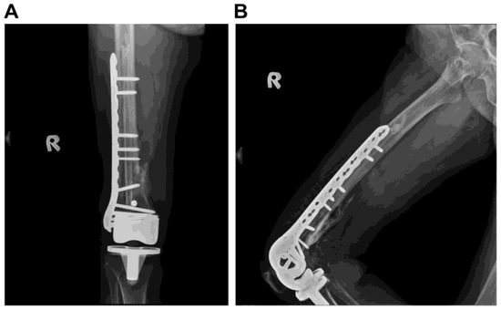Successful Plate Fixation with Long Intramedullary Fibula Bone Graft ...