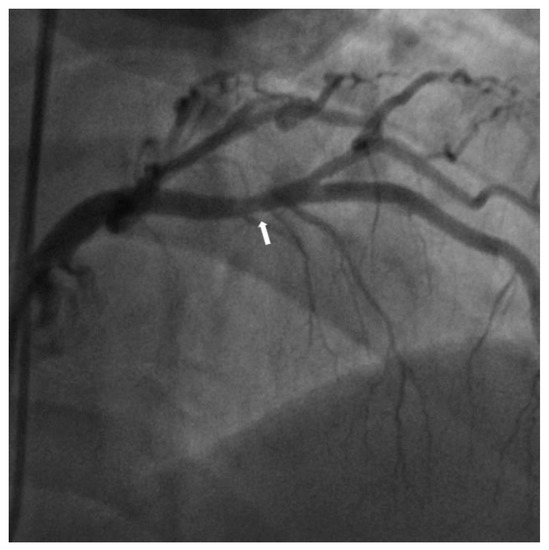 Near-Infrared Spectroscopy Intravascular-Ultrasound-Guided Intervention ...