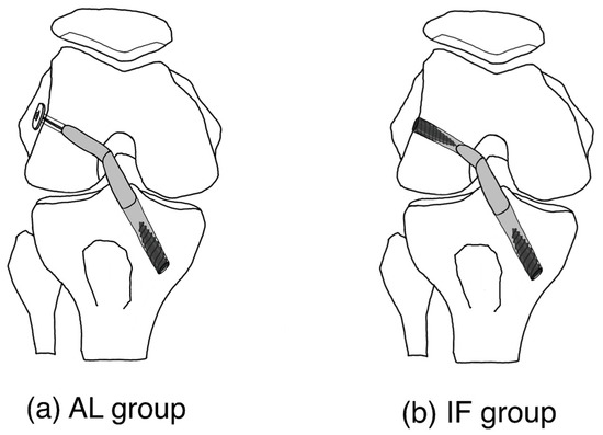Adjustable-Loop Cortical Suspensory Fixation Results in Greater Tibial ...