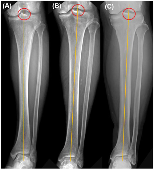 Accuracy of the Tibial Component Alignment by Extramedullary System Using Simple Radiographic ...