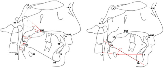 The Link between Obstructive Sleep Apnea Syndrome and Cephalometric ...