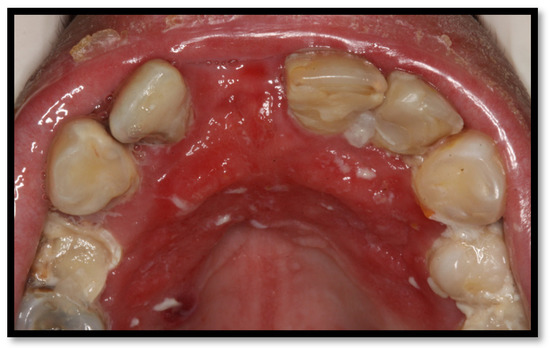 Oral Manifestations Associated with HIV/AIDS Patients