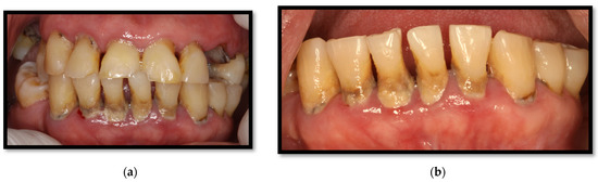Oral Manifestations Associated with HIV/AIDS Patients