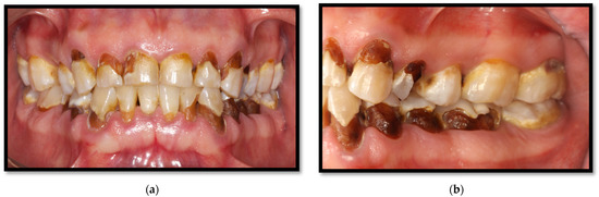 Oral Manifestations Associated with HIV/AIDS Patients