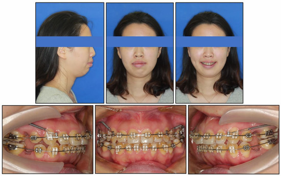 Vertical Control of a Severe Hyperdivergent Skeletal Class II ...