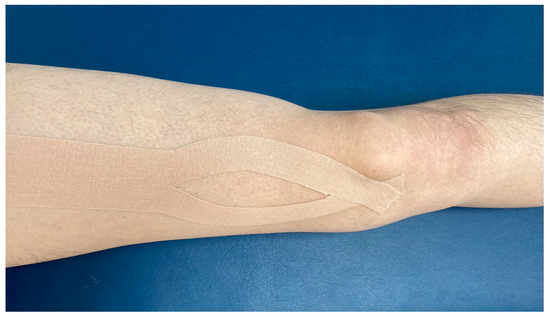 Effects of McConnell and Kinesio Tapings on Pain and Gait Parameters ...
