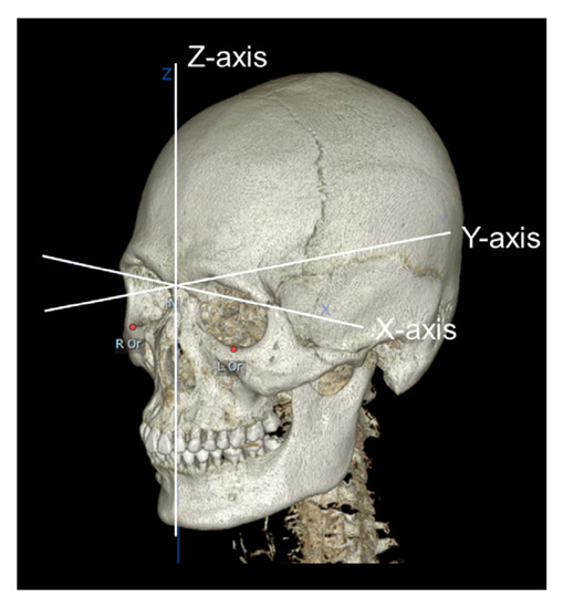 Anatomical Characteristics of the Accessory Maxillary Ostium in Three ...