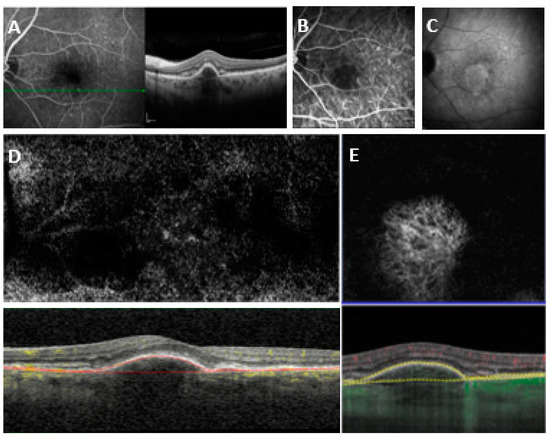 Undetectable Macular Neovascularization on OCT Angiography in Age ...