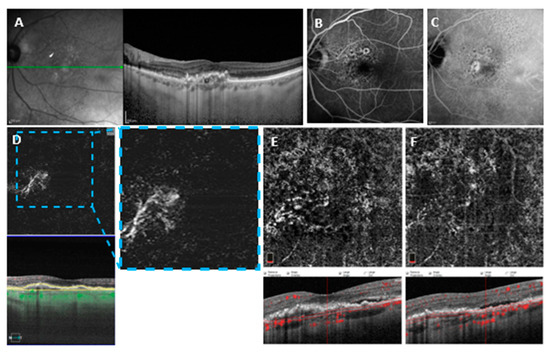 Undetectable Macular Neovascularization on OCT Angiography in Age ...