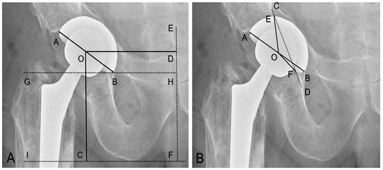 Medicina | Free Full-Text | Revision of a Failed Primary Total Hip ...