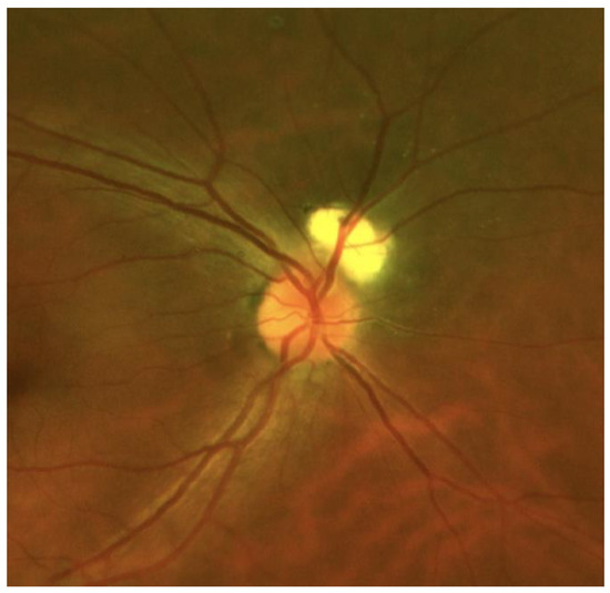 Juxtapapillary Choroidal Neovascularization in a Young Woman with ...